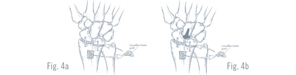 Curare l'artrosi del polso parziale | Dr. Borelli