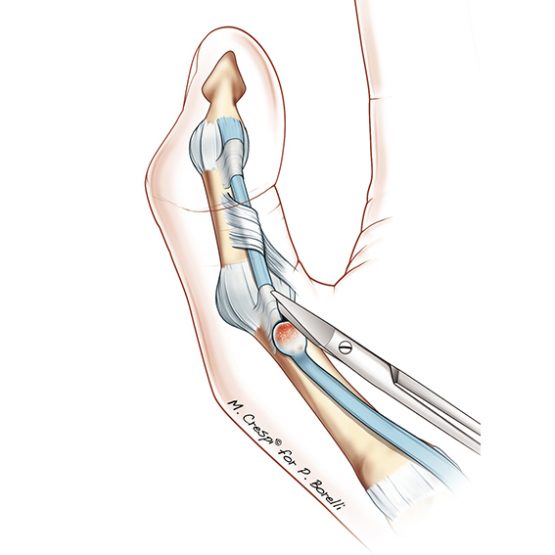 Il pollice a scatto - Dito a scatto - Dr. Borelli