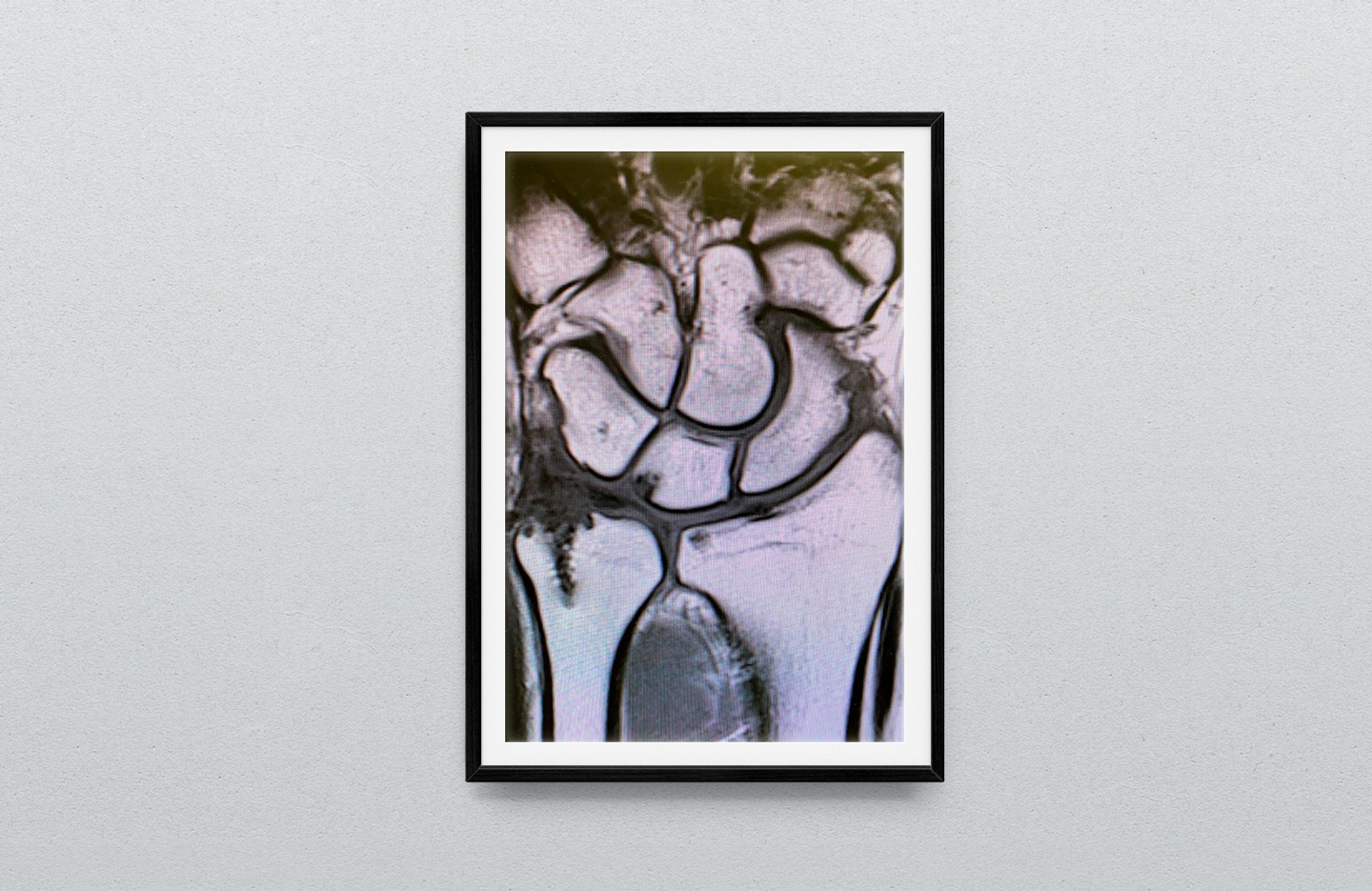 How to manage TFCC after ulnar styloid resection? - Chirurgia della ...