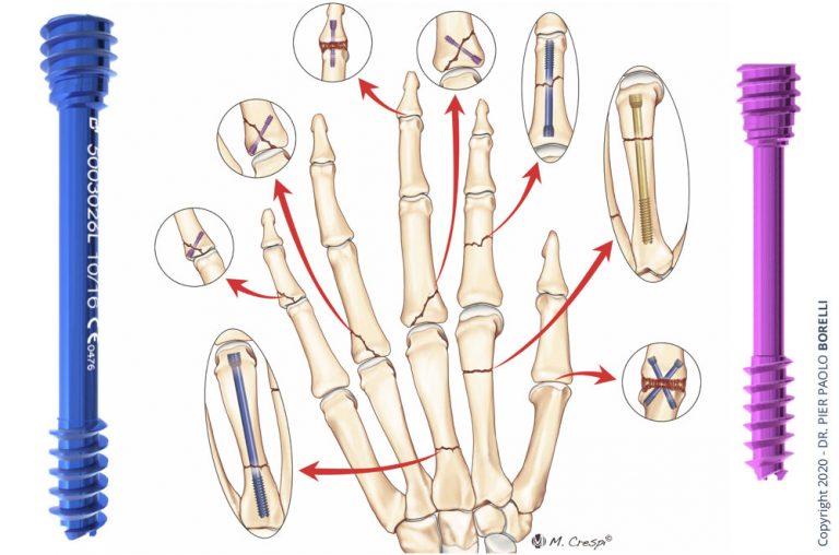 Intramedullary cannulated headless screw fixation for metacarpal and ...