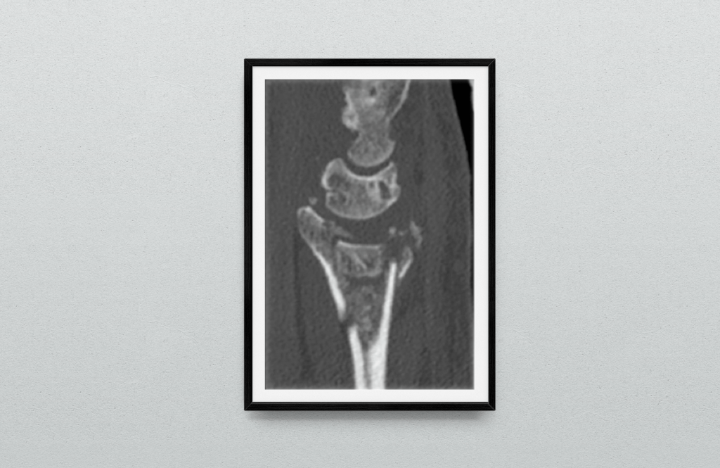 The dorsal approach in Distal Radial Fractures: when and how ...