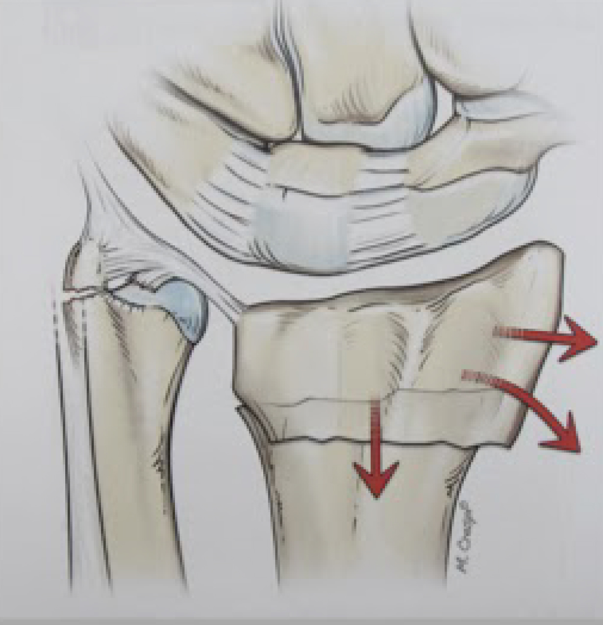 Vizi di consolidazione nelle fratture del polso - Aggiornamento 2020
