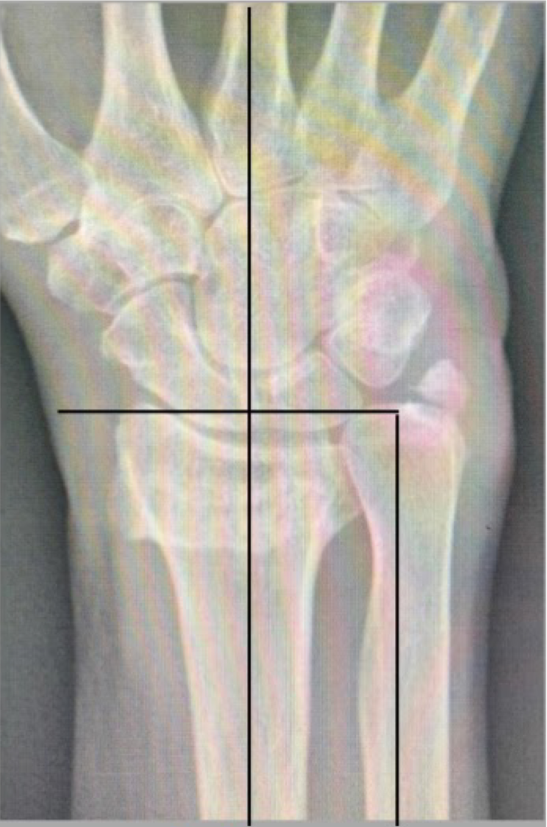 Vizi di consolidazione nelle fratture del polso - Aggiornamento 2020