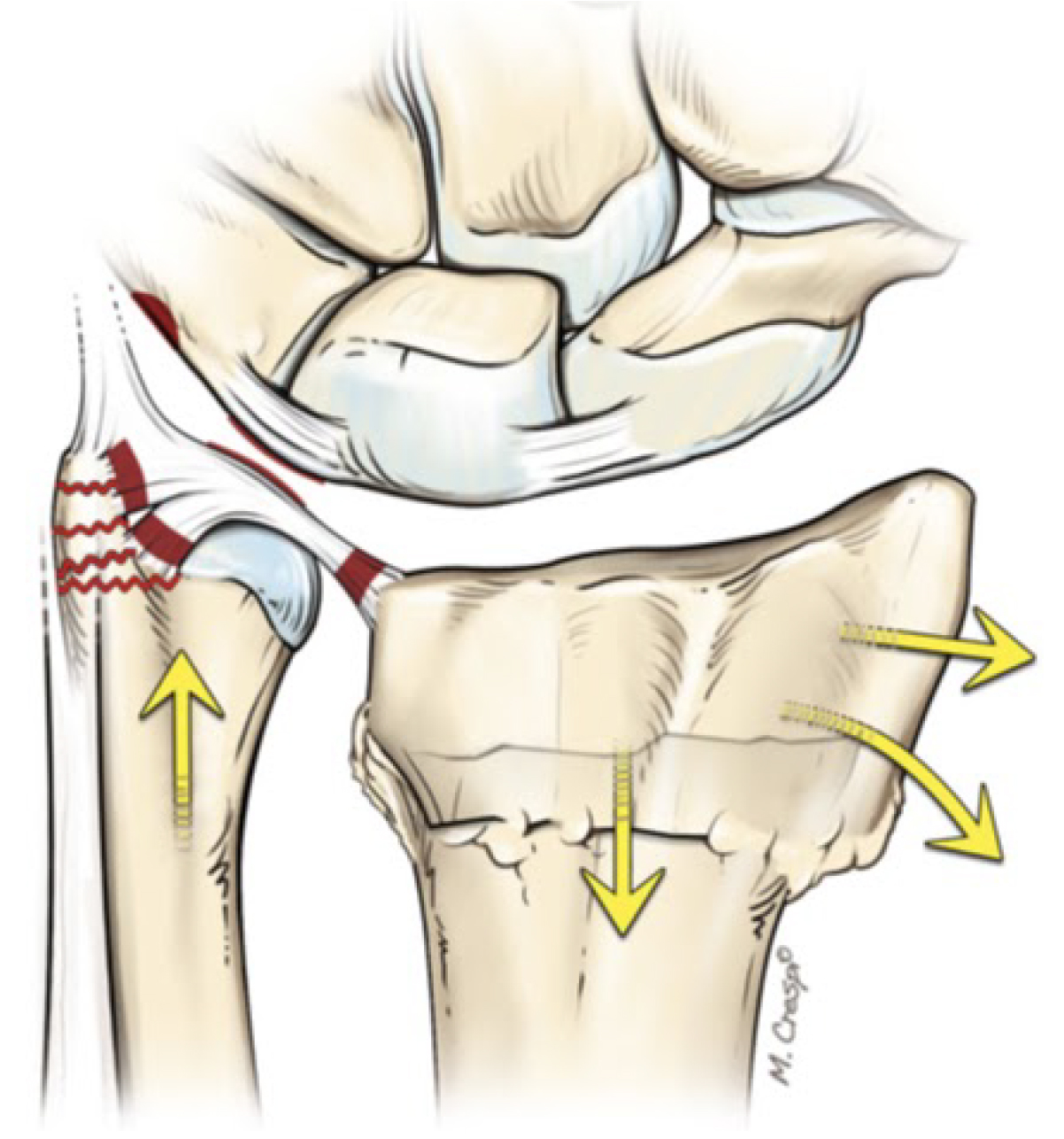 Vizi di consolidazione nelle fratture del polso - Aggiornamento 2020