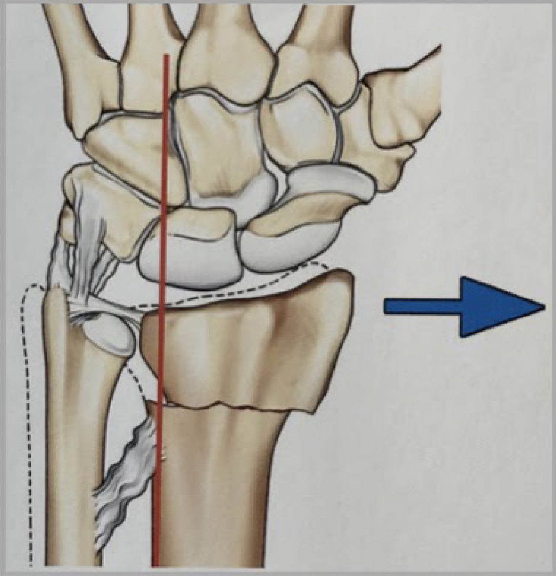 Vizi di consolidazione nelle fratture del polso - Aggiornamento 2020