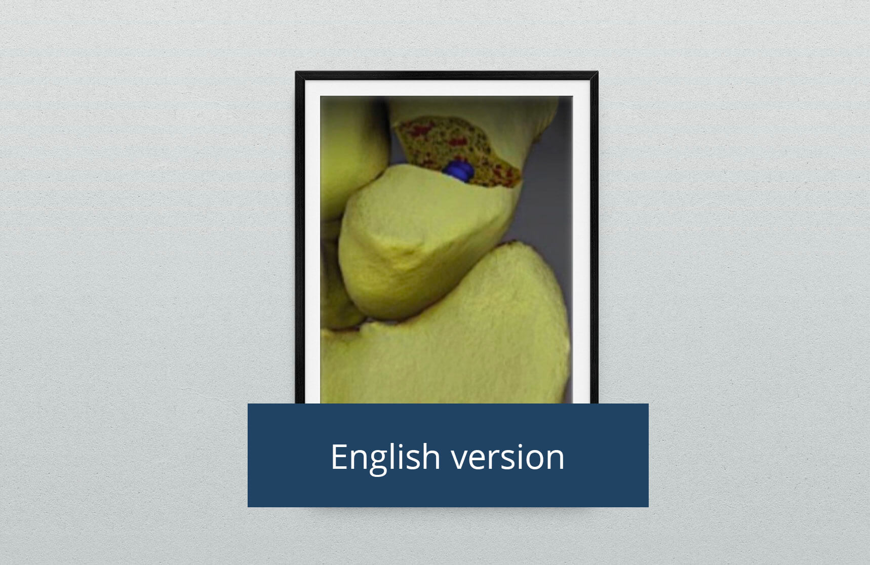 Scaphoid nonunion. Evidence Based management in 2023. - Chirurgia della ...