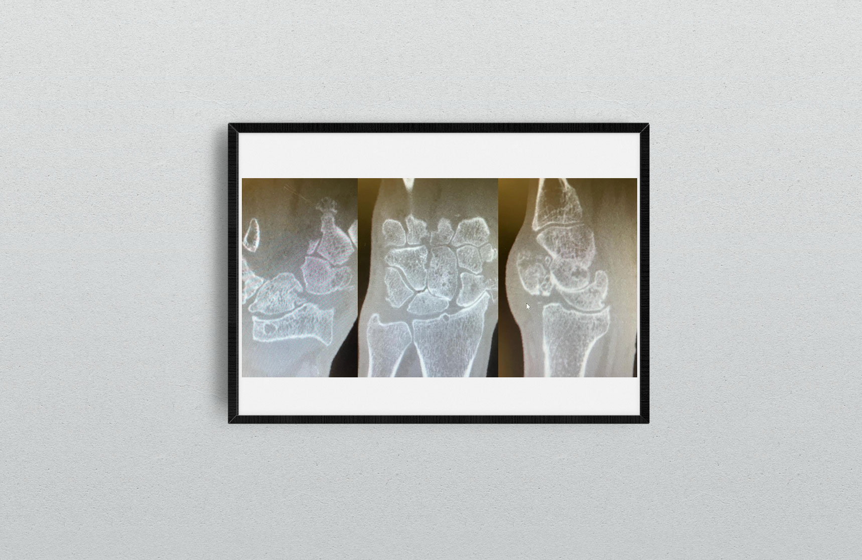 Wrist Prosthetic Replacement: a new perspective as “option treatment ...
